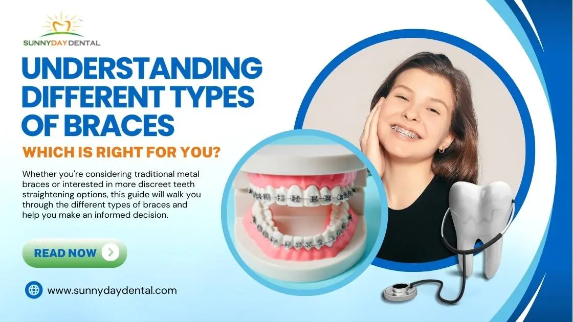 Different Types of Braces: Which Is Right for You?